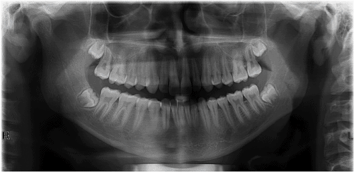 Xray Of Perfect Teeth